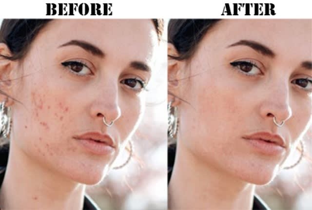 Remove pimples or acne and enhance your photo by Clarkdelaplaza | Fiverr