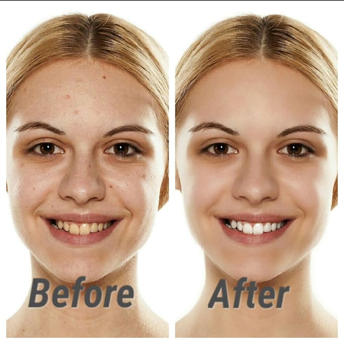 Remove pimple and spots from your face and make it clean by ...