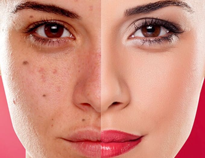 Removing pimples and blemishes, facial retouching by Samtv1 | Fiverr