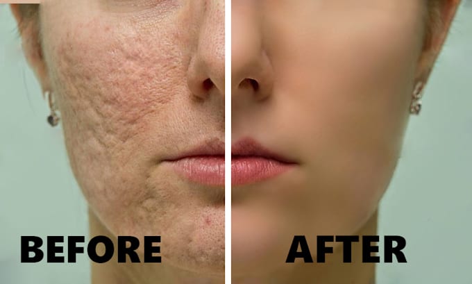 Do skin, beauty retouching, pimples, wrinkles, blemishes, softening in ...