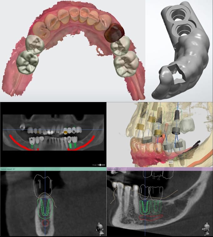 Design your implant surgery with 3d surgical guide by Archident | Fiverr
