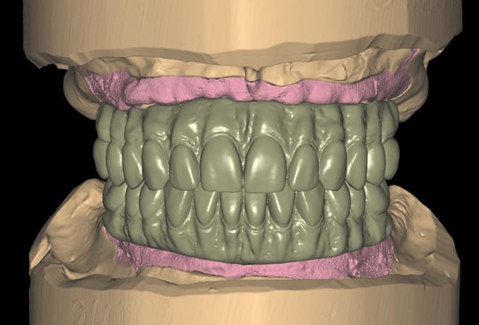 Design a full contour crown or cutback crown using exocad to your ...