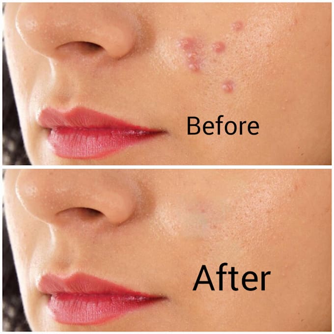Face rash pimples removal background change editing images by ...
