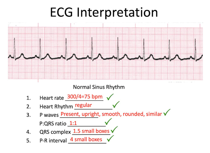 Solve any ecg in few minutes by Fekherjaoued | Fiverr