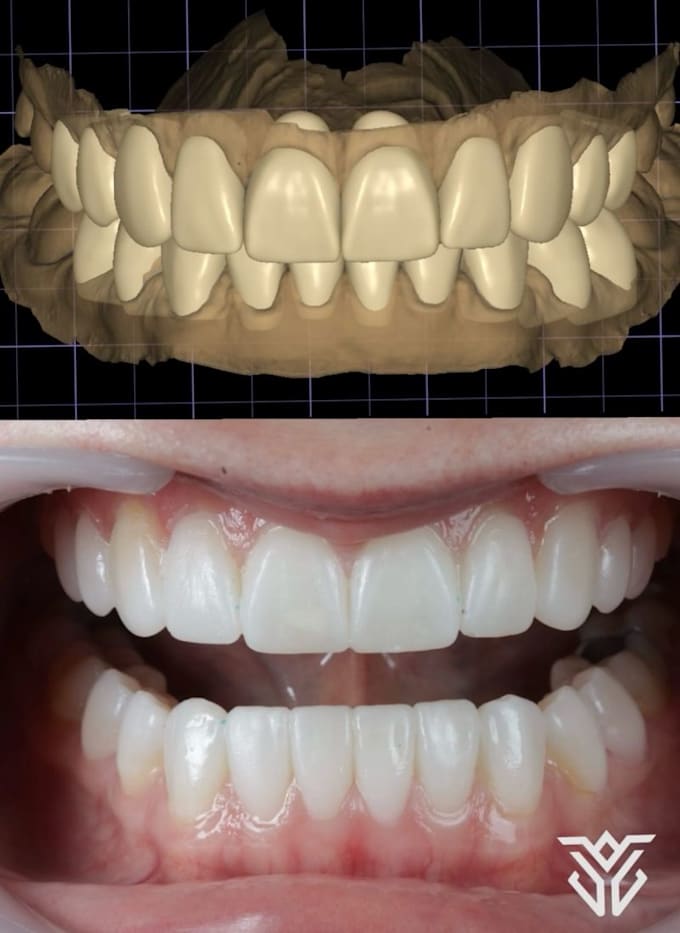 Design digital waxup and dsd by Yakout97 | Fiverr