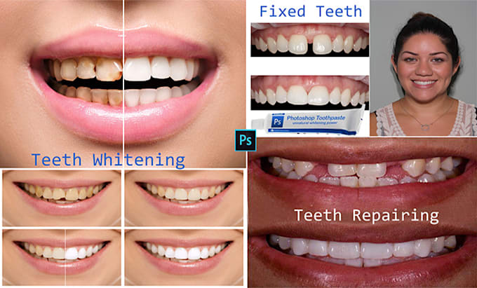 Repair,fix,and whiten teeth in photoshop 100 image within 24hours by ...