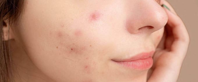 Retouch your skin, remove your pimples and acne in photoshop by ...