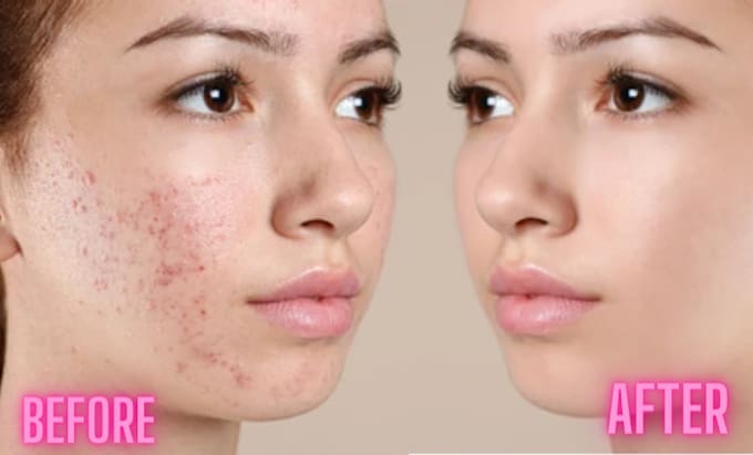 Come to edit your face with acne spots, without any pimples by ...
