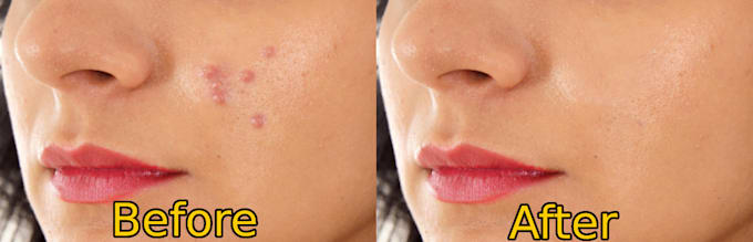 Remove marks on skin like pimples black spots etc by Malinda_1994 | Fiverr