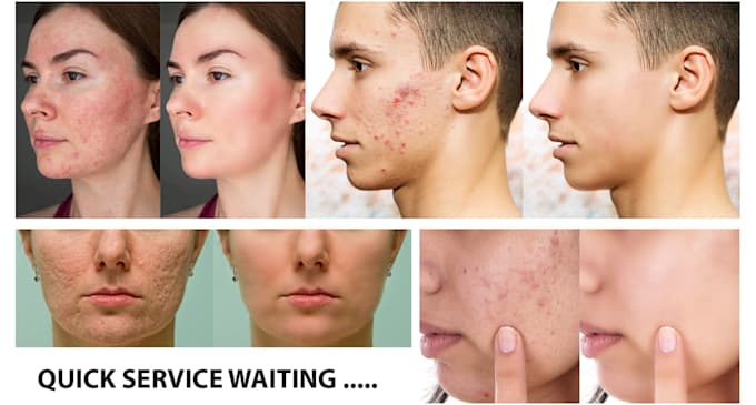 Retouch your image remove pimples, wrinkles, acne and blemishes with ...