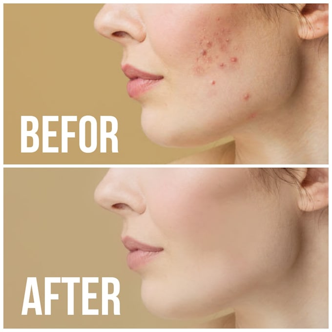 Retouch your skin, remove your pimples and acne in photoshop by ...