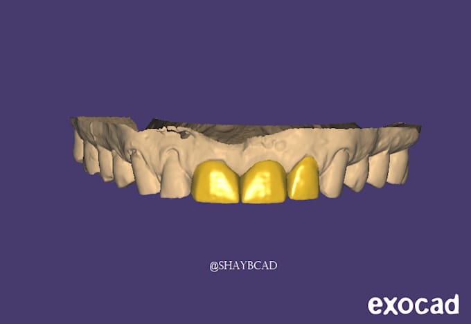 Design top quality exocad crown n bridges by Abdullahsdar | Fiverr