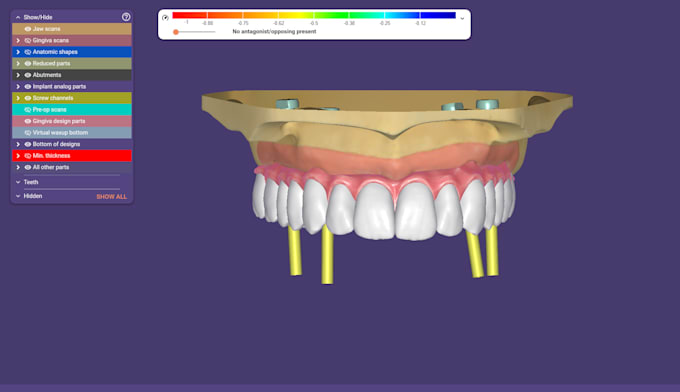Design all your dental restoration with exocad by Rigers13 | Fiverr