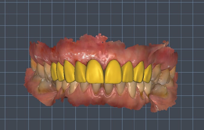 Design reduced bridges, full anatomic bridges, veneers, inlays,onlays ...