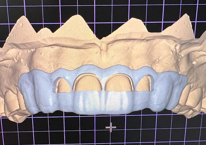 Design gingivectomy and bone reduction guide in one in exocad by ...