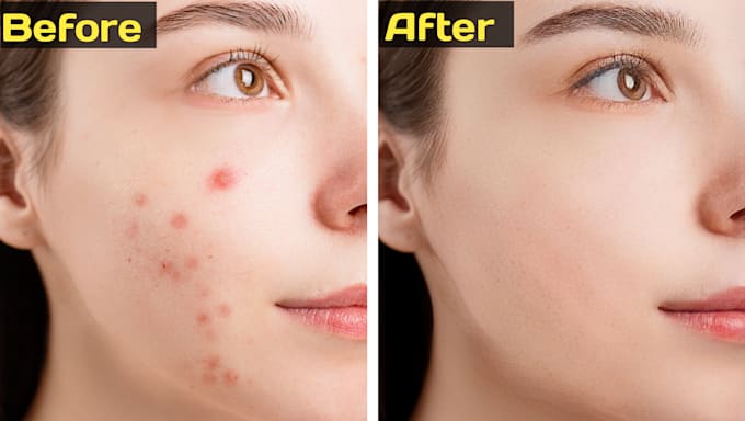 Transform your skin expert pimple removal editing by Ishanfernand409 ...