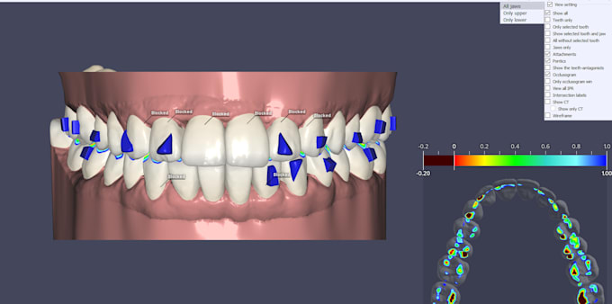 Create clear aligner treatment plans by Akadiryazici | Fiverr