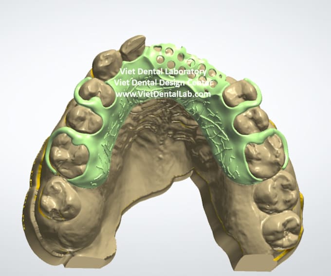 Design removable partial denture frameworks cheap by Vietdentallab | Fiverr