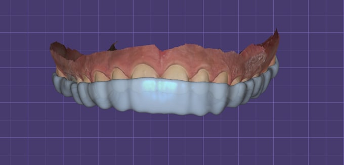 Bruxism splint, nightguard design by Cankilicaslan | Fiverr