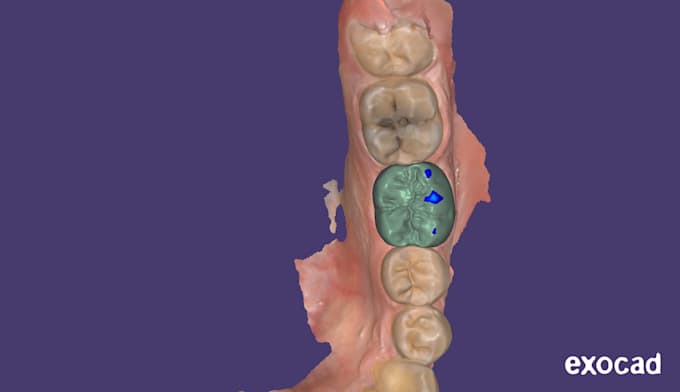 Do you crown, veneer, inlay, onlay on exocad and delivery on same day ...