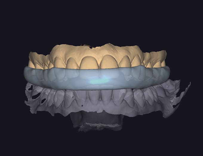 Design a bite splint in exocad, with canine or anterior guidance by Anapr93 | Fiverr