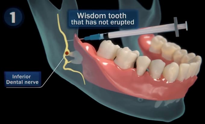Do 3d dental animation 3d medical animation and wisdom teeth extraction ...