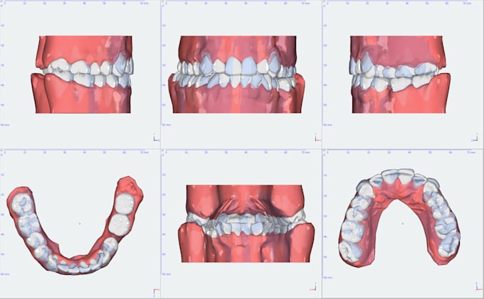 Prepare expert aligner plans, 3shape,onyxceph by Glossydentalx | Fiverr