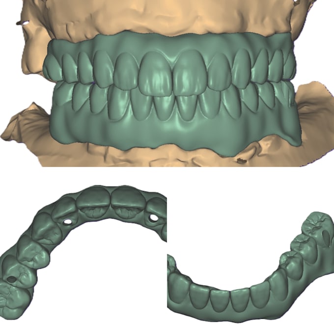 Dental cad designs for crowns, bridges and implants using exocad and ...