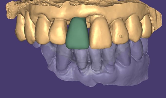 Design dental crowns, bridges, and veneers in exocad by Alnovoselsky ...
