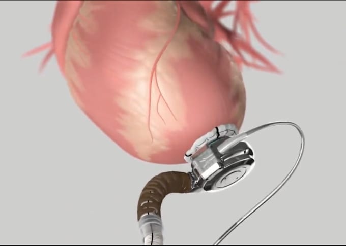 3d medical animation 3d surgical procedure 3d medical device explainer ...