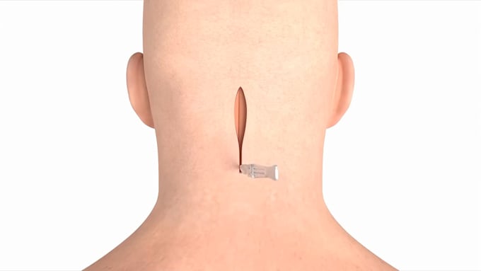 Do 3d medical device animation 3d surgical device animation 3d medical ...