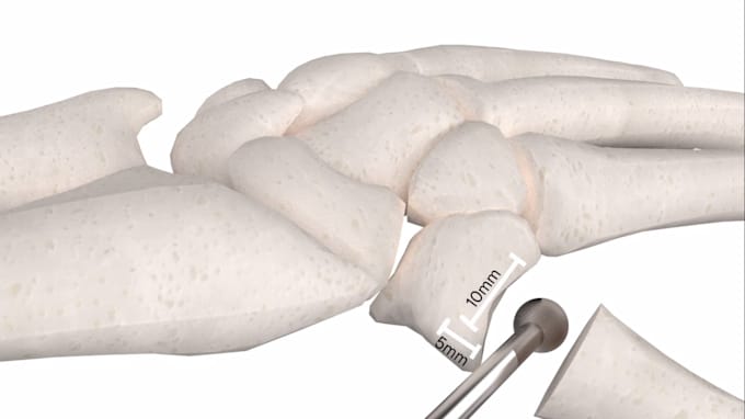 Create surgical procedure animation, medical explainer, surgical device ...