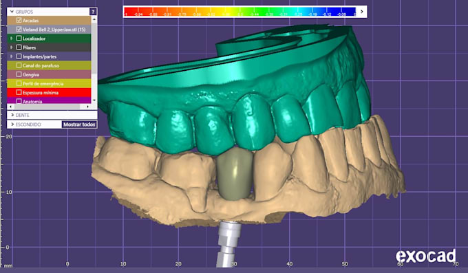 Design cad in exocad by Maxcad3d | Fiverr