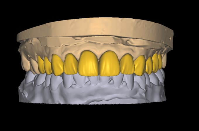 Design a full arch crown restoration with high precision using exocad ...