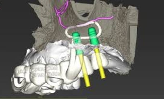 Guide sinus lift lateral approach by Kirllosatef | Fiverr