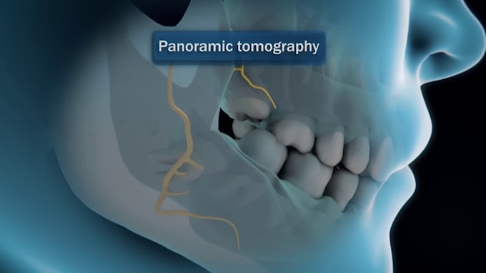 Design 3d detailed dental extraction 3d medical procedure animation by ...