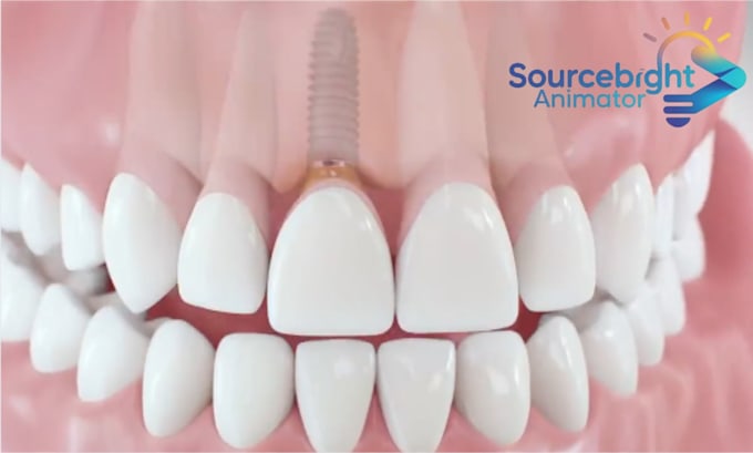 Create realistic 3d dental implant animation for patient education by ...