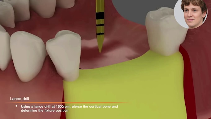 Create 3d medical animation 3d dental implant video dental surgery ...