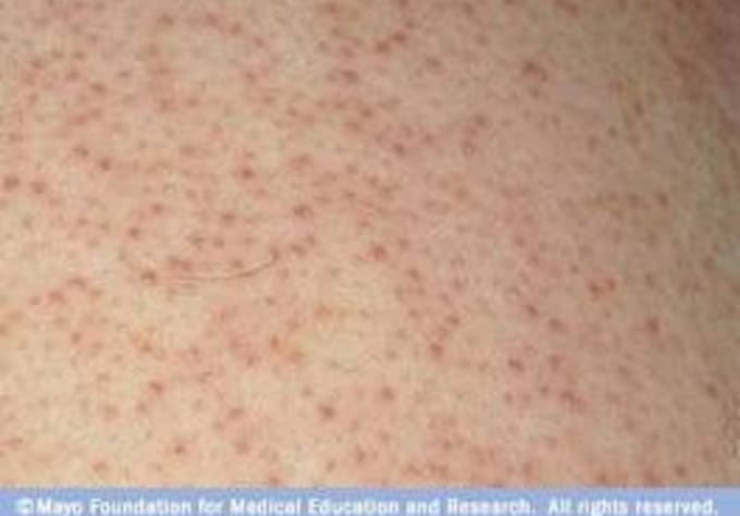 Show you how to prevent jock rash by Shannoncormier | Fiverr