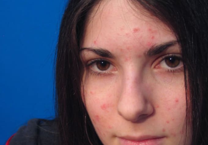 Remove blemishes from your face using lightroom by Sisterkate | Fiverr