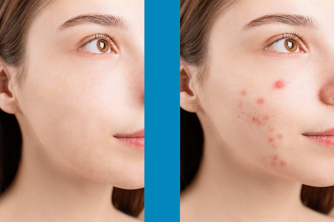 Retouch your image remove pimple, wrinkles, acne and blemishes using ...