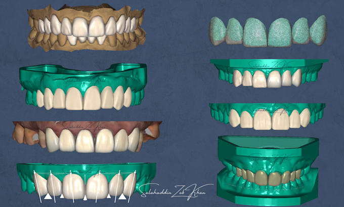 Do 2d and 3d digital smile designs for you using exocad by Caddentist ...