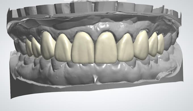 Design full mouth waxup, bridges, crowns, veeners using 3shape by ...