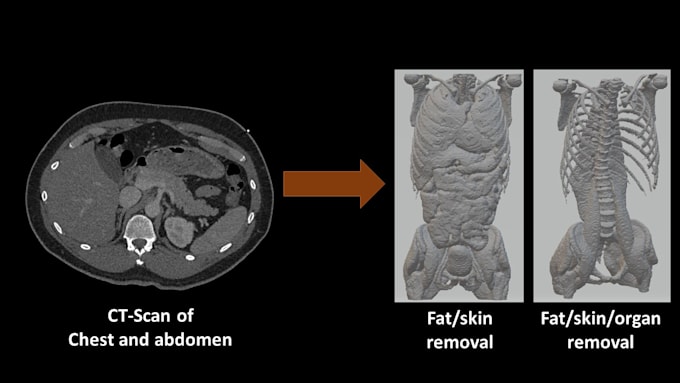 Generate 3d models of your organs or bones based on your ct scan by Radiology_3d | Fiverr