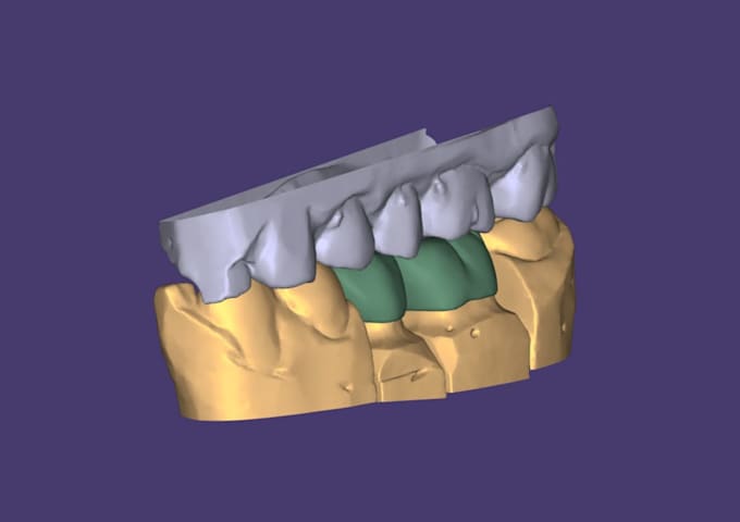 Design high quality crown and bridge using exocad by Arneelayug | Fiverr