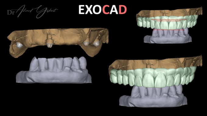 Screw retained prosthesis crowns, bridges, full arch by Yakout97 | Fiverr