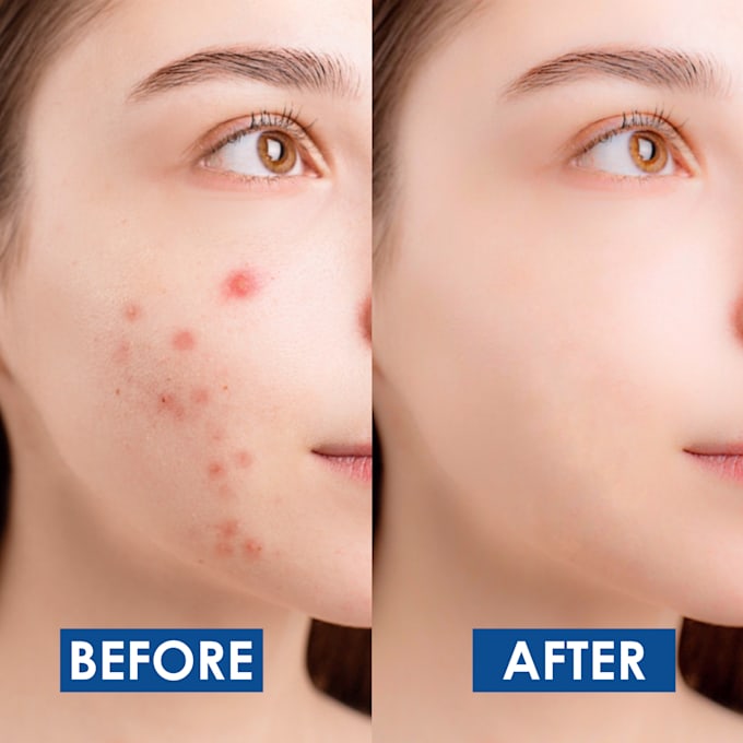 Face retouching , removing pimples and dark spots by Kasundilhara431 ...