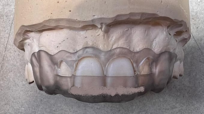 Design gingivectomy and bone reduction guide in one in exocad by ...