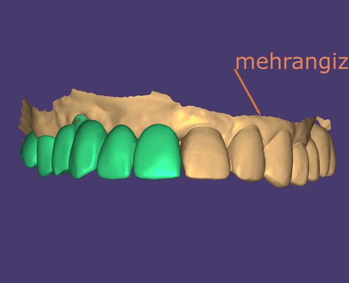 Design crowns veneers inlay onlay overlay using exocad by Amiretr0 | Fiverr