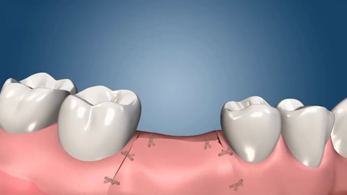 Realistic 3d dental animation 3d surgical explainer video 3d medical ...
